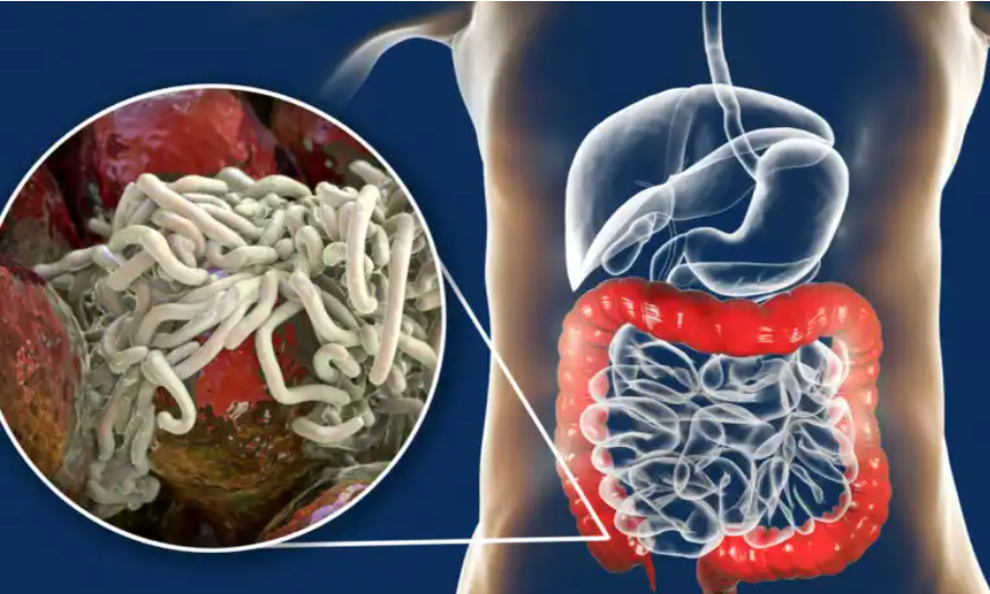 Infección intestinal por oxiuros