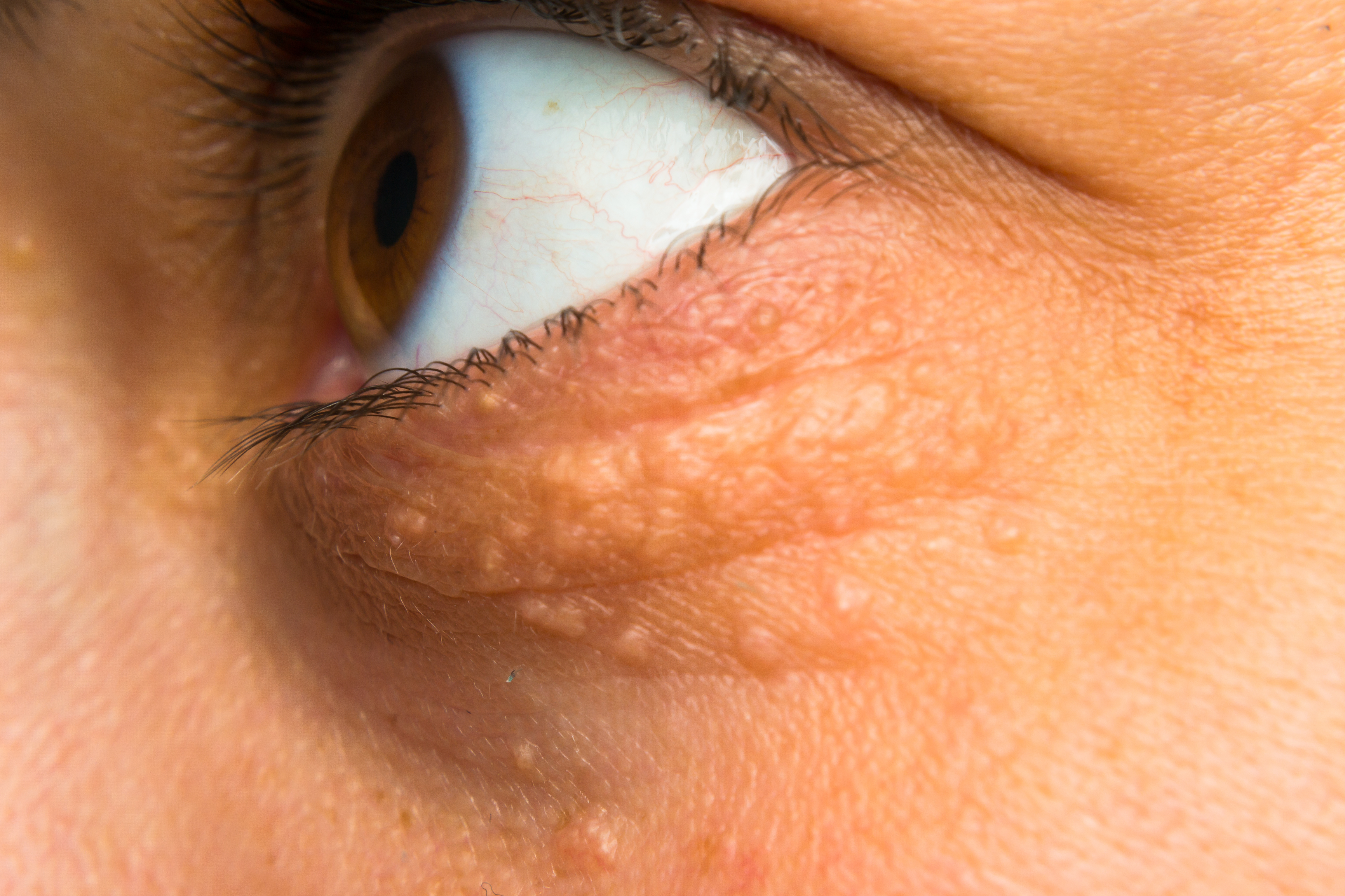 Xantelasma Causas Xantelasma: O Que é E Como Tratar? Clínica Dra.