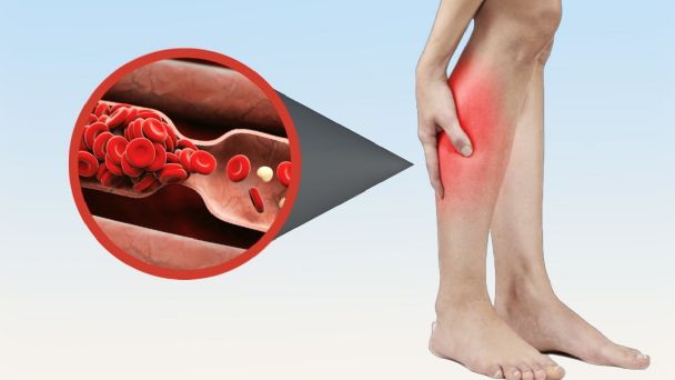 ¿Qué es una trombosis?